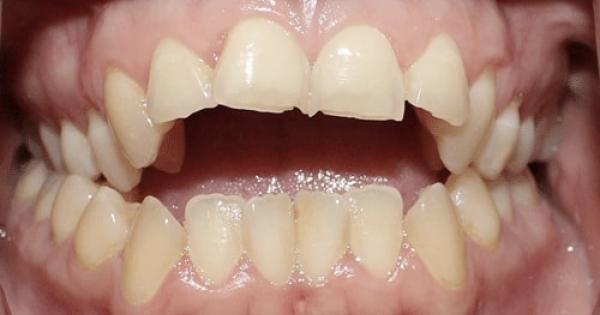 End To End Bite Teeth